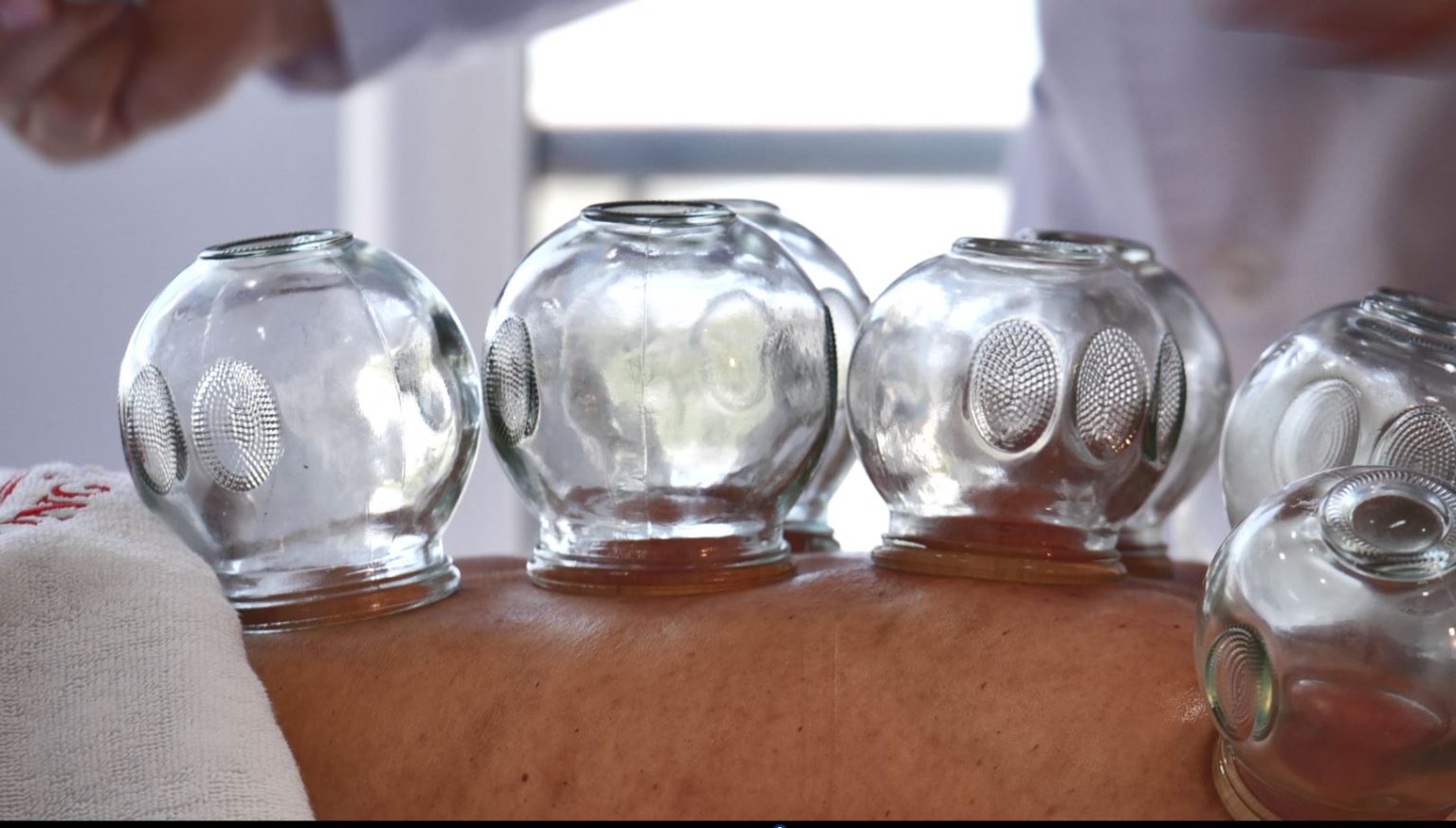 Cupping and Hijama: The Synergy:Understanding the Blend of TCM and ...